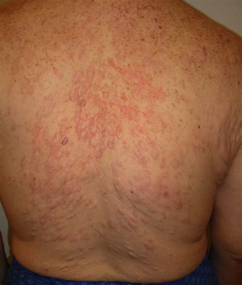 Anetoderma Causes Symptoms Diagnosis And Treatment