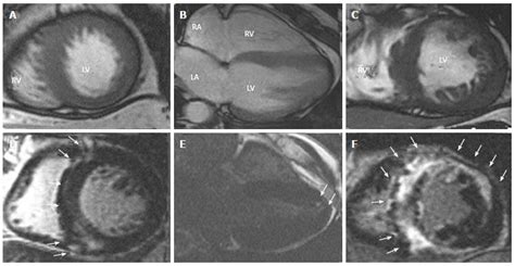 Distribution Of Late Gadolinium Enhancement In Various Types Of