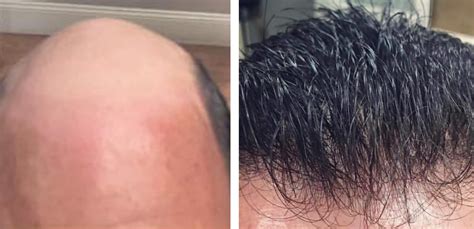 Hair Loss Cure For Male Pattern Baldness And Receding Hairline