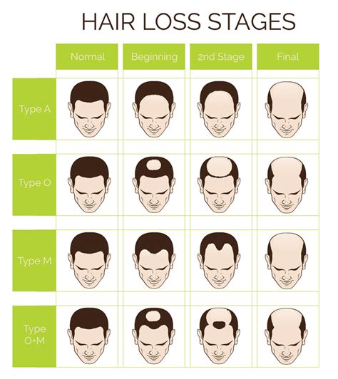 Male Pattern Baldness Stages Renew Physical Therapy