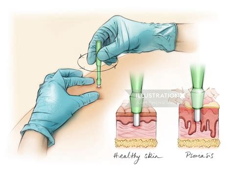 Punch Biopsy Illustration By Juliet Percival Medical