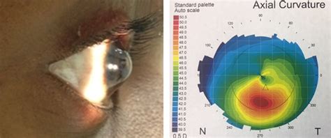 Premier Medical – Baldwin County Keratoconus Treatment – Avedros Kxl