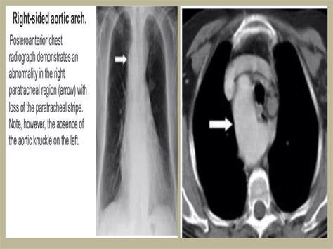 Presentation1 Pptx Radiological Imaging Of Mediastinal Masses Ppt