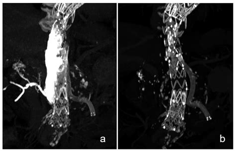 Life Free Full Text Endovascular Aneurysm Sac Embolization For