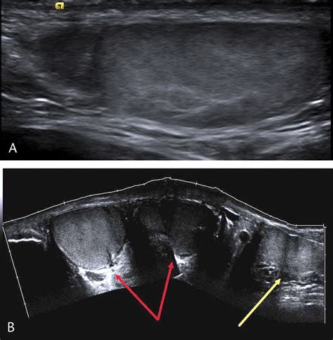 Polyorchidism A Review Of The Literature And Case Report Of