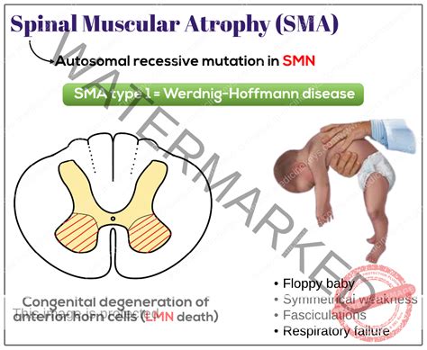 Spinal Muscular Atrophy Sma Medicine Keys For Mrcps