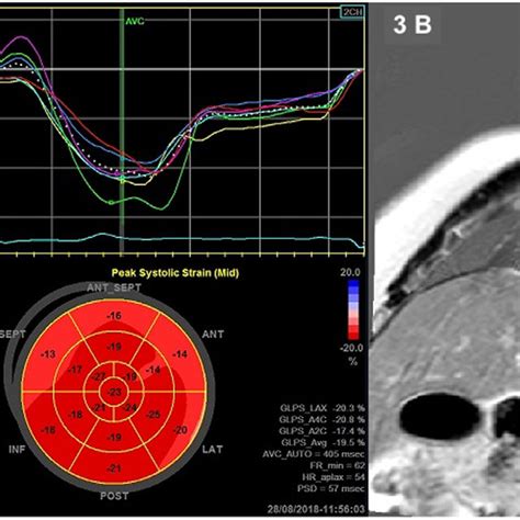 The Example Of Late Gadolinium Enhancement Lge − In A Patient With