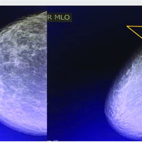Craniocaudal Left And Mediolateral Oblique Right Mammogram Images