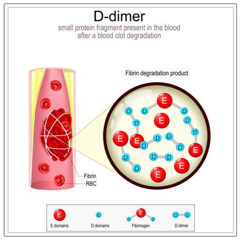 D Dimer Test Definition Diagnosis And What To Expect Egiomed