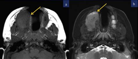 Melanotic Neuroectodermal Tumor Of Infancy Semantic Scholar