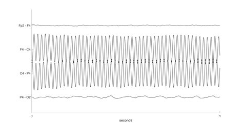 Common Physiological Eeg Artifacts Tmsi