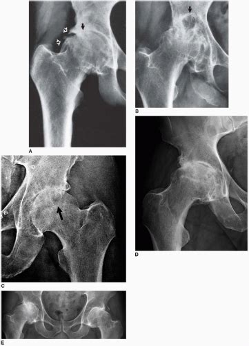 Degenerative Joint Diseases Radiology Key