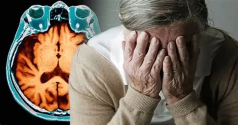 علائم و مراحل آلزایمر معرفی بیش از 10 علامت رایج آلزایمر