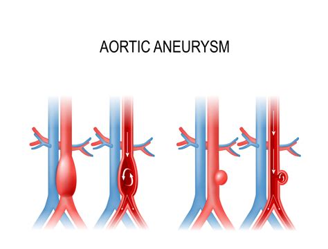 Aortic Aneurysm Miami Vascular Specialists