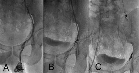 Varicocele Treatment
