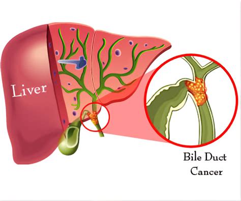 Bile Duct Cancer Treatments Causes And Symptoms Nhcancerclinics