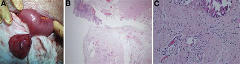A Rare Benign Gastrointestinal Lesion Identified As A Calcifying
