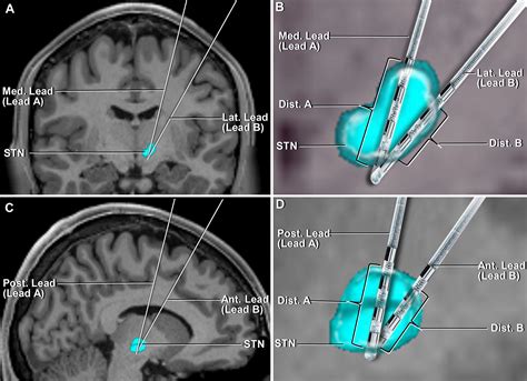 Microsurgical Anatomy Of The Subthalamic Nucleus Correlating Fiber