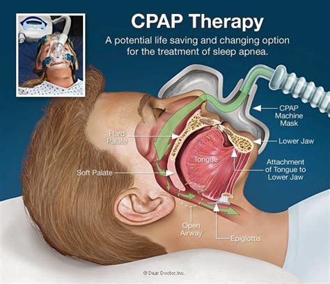 Cpap Presión Continua Positiva De Las Vías Aéreas Respiratory