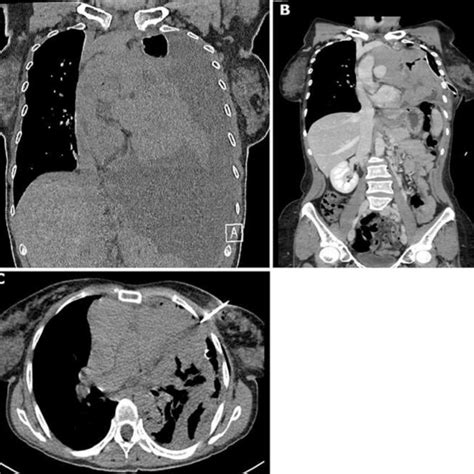 A Thoracic Computed Tomography Ct Scan Demonstrating A Giant
