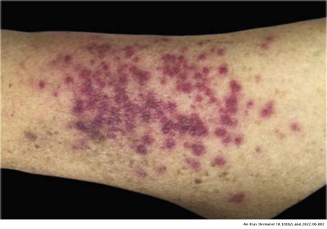 Dermatological Manifestations Of Hematologic Neoplasms Part I