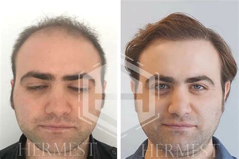 Top 20 Best Hair Transplants In Turkey And Cost In 2023