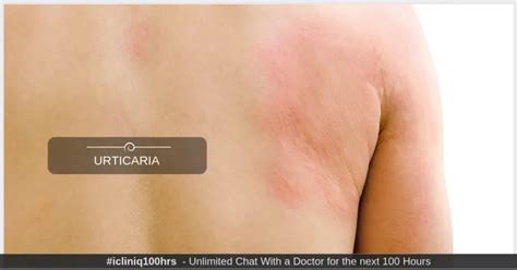 Urticaria Treatment