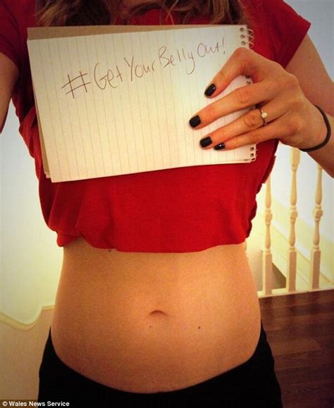 Ileostomy Scar