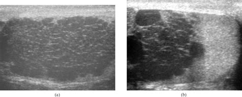 A Longitudinal Ultrasound Of The Right Testis Utilizing A 7 5 Mhz