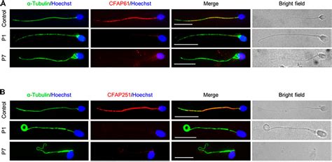Frontiers Biallelic Variants In Cfap61 Cause Multiple Morphological
