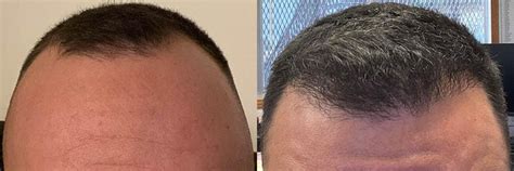 42 Year Old Caucasian Brown Fue Hair Transplant Before After Result