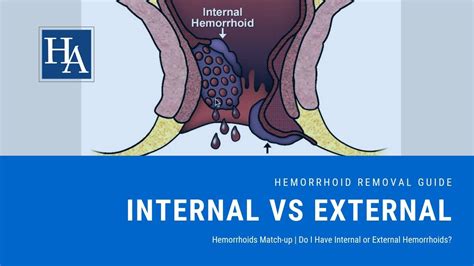 Internal Versus External Hemorrhoids Match Up Do I Have Internal Or