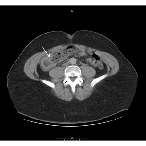 A Computed Tomography Ct Scan Of The Abdomen A Axial Ct Scan At