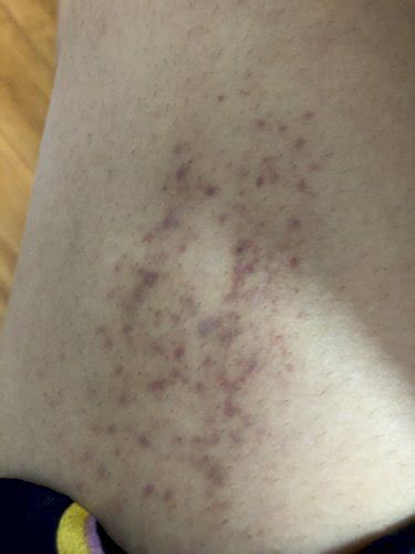 ※閲覧注意※ 中学生女子です。 一昨日くらいから太ももに赤紫色の斑点が 皮膚の病気・アレルギー 教えて Goo