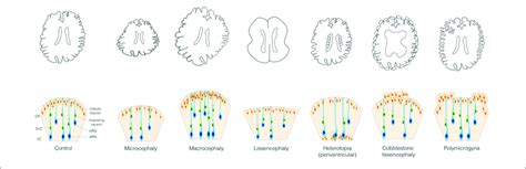 Malformations Of The Cortical Development Upper Schematic