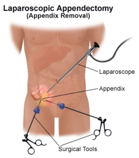 Symptoms Of Appendicitis And Ruptured Appendix Know What To Look For