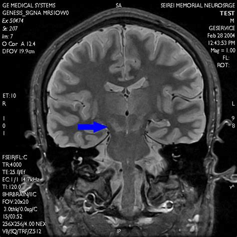 Subthalamic Nucleus