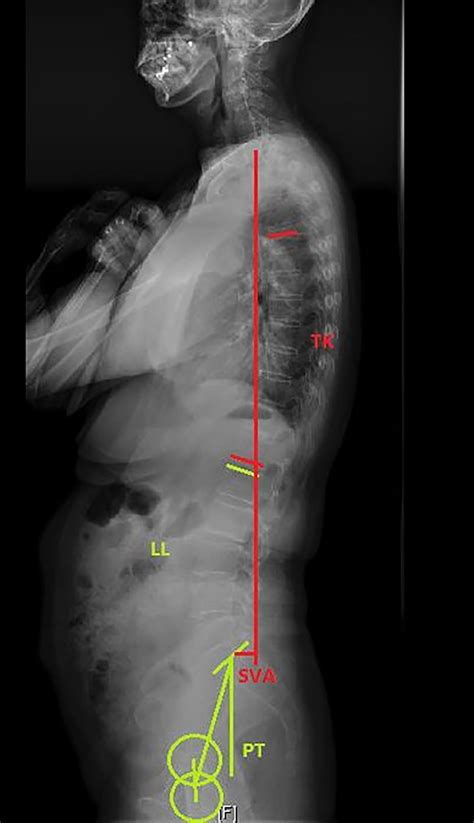 Measurements Of Spinopelvic Sagittal Parameters Including Sva Pt Ll