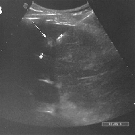 univariate and multivariate analyses of pretransplantation factors