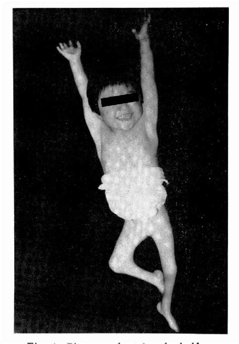 Figure 1 From Complete Sacral Agenesis A Case Report Semantic Scholar