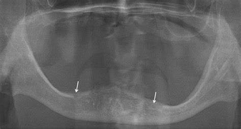 A Panoramic Radiograph Shows Severe Alveolar Bone Loss And Both Sides