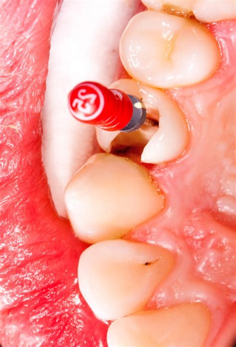 Tooth Treatment Angela Evanson Dds In Parker Co Dentist 720 409