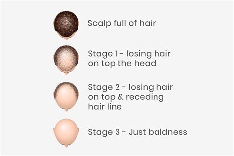 Stages Of Male Pattern Baldness Infographic
