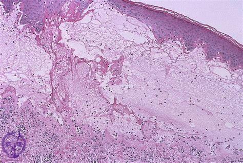 20 Skin 2 Vesiculobullous Disease Pemphigus Vulgaris Pathology Core