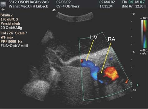 Ductus Venosus Ultrasound