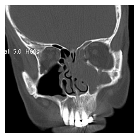 Paranasal Sinus Computed Tomography Showing A Soft Tissue Lesion