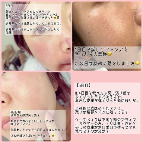 ダーマスキンピーリング｜bqcellの効果に関する口コミ ・ Bqcell ダーマスキンピーリング By 𝙼𝚒𝙺𝚒𝚝𝚝𝚢🧸💓む 混合肌