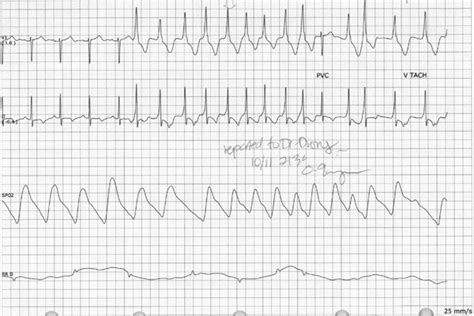 A Normal Sinus Rhythm No St Segment Elevations Or Depressions And