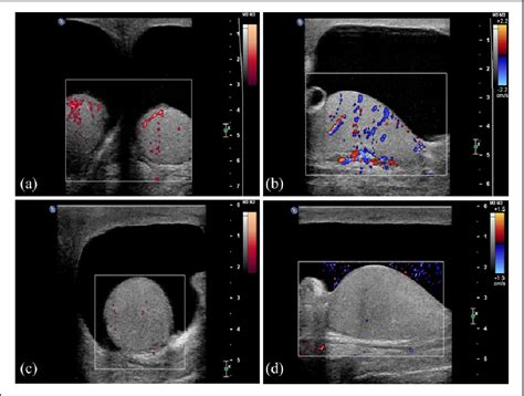 Figure 1 From Testicular Granulomatous Vasculitis Mimicking Testicular