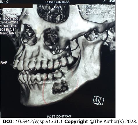 Cemento Ossifying Fibroma Of The Left Mandible A Case Report